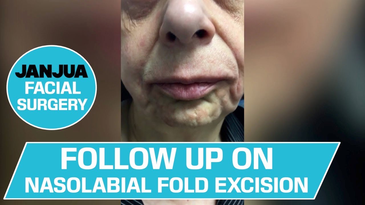LONG TERM FOLLOW UP ON NASOLABIAL FOLD EXCISION- DR. TANVEER JANJUA ...