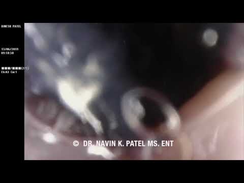 DRUG INDUCED SLEEP ENDOSCOPY 2 - YouTube