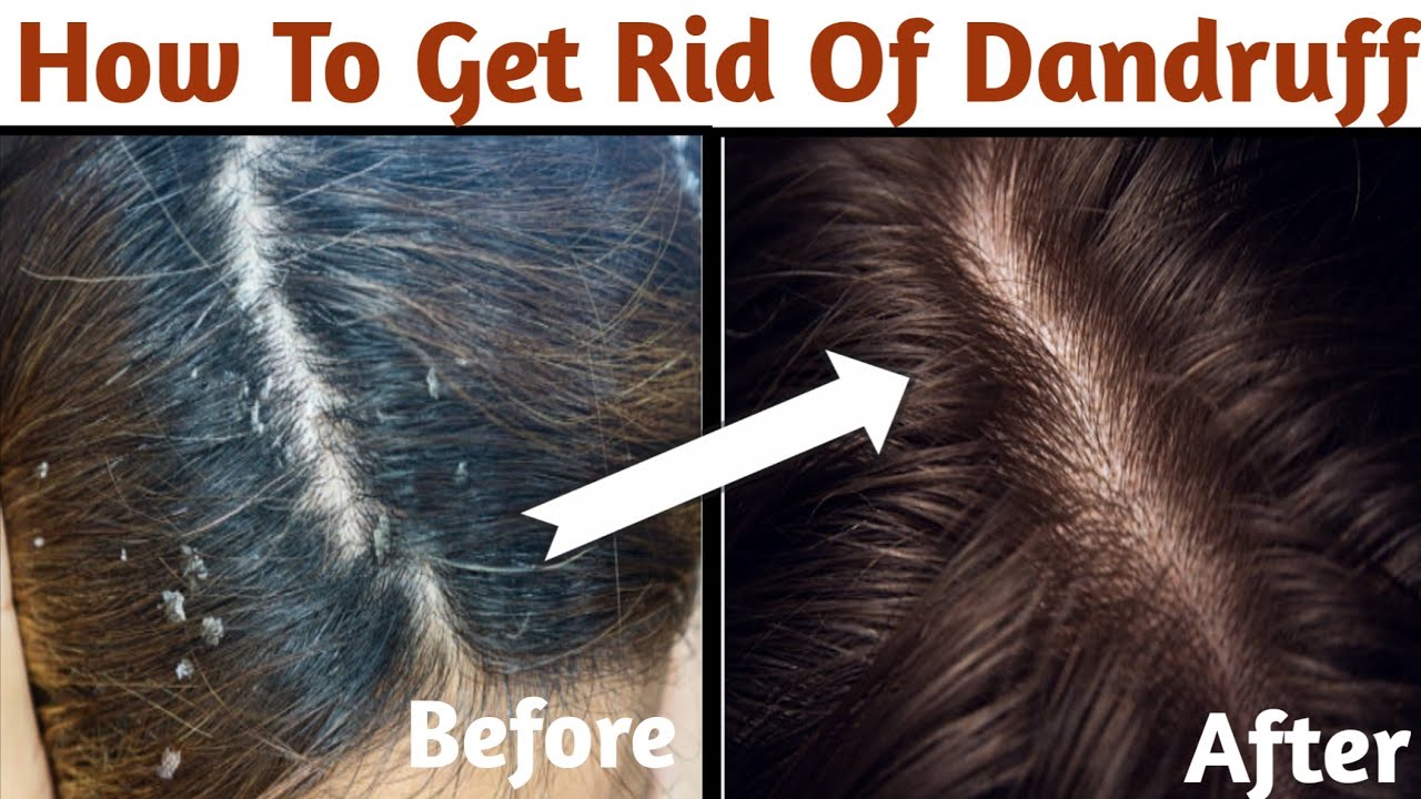 Dandruff Treatment At Home| Dandruff Removal | Natural Remedies For ...