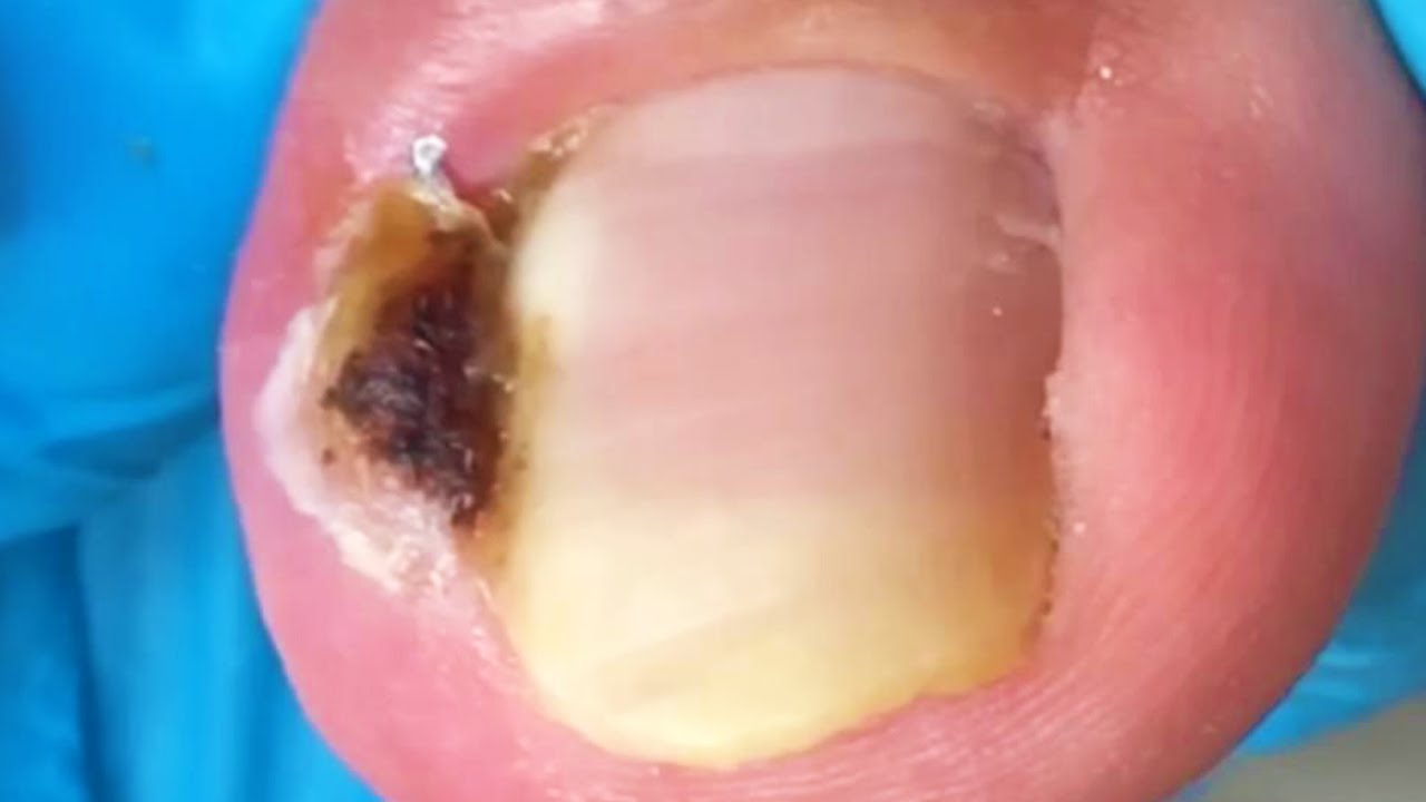 Treat Paronychia, Oversized Ingrown Toenails!【Crazy pedicure room ...