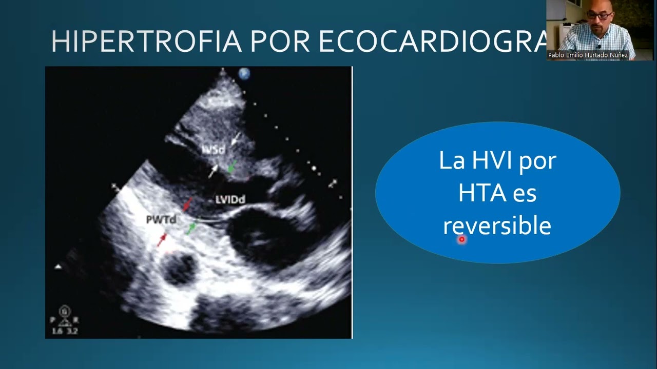 Eco De Hipertrofia Ventricular Izquierda