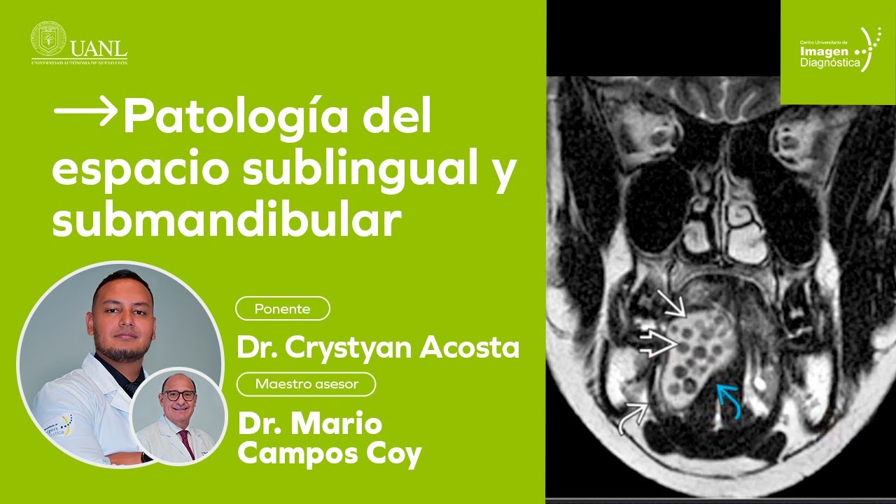 Patología del espacio sublingual y submandibular por el Dr. Crystyan ...