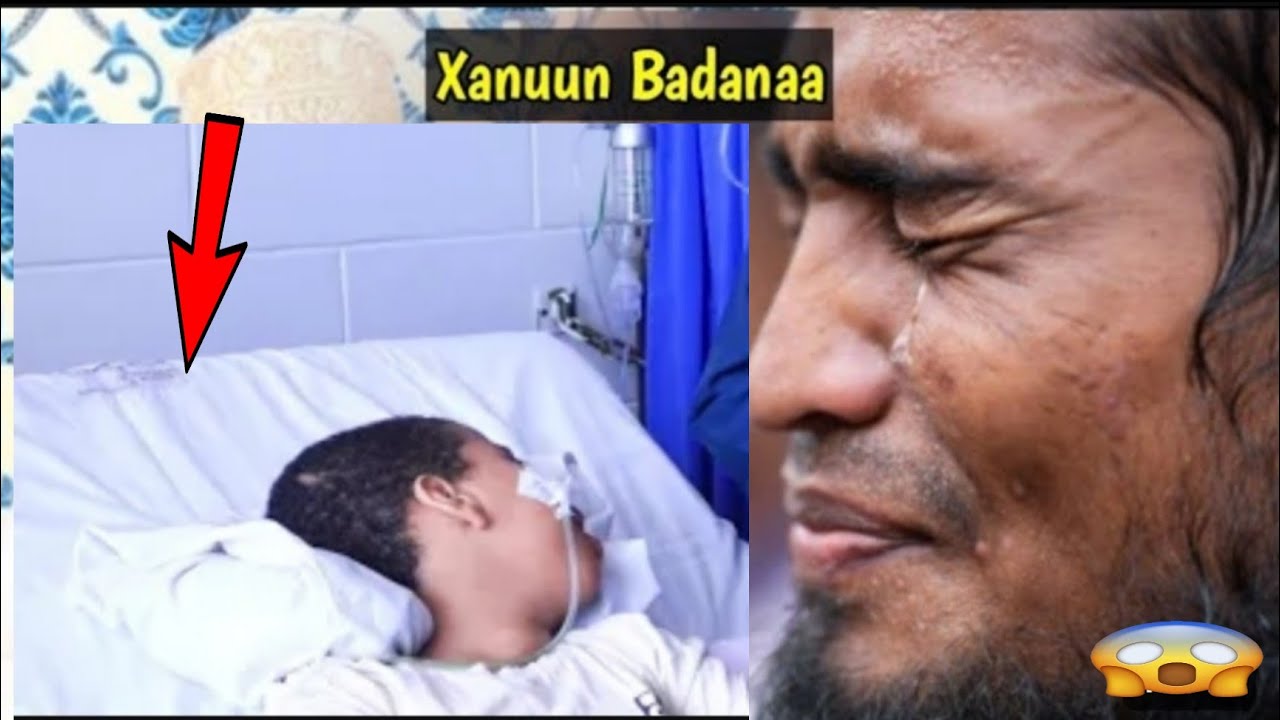 Xanuun Daran Ayaaku dhacay Nafta ayuuka Sabray Wuxu Isku Daweeyay O ...