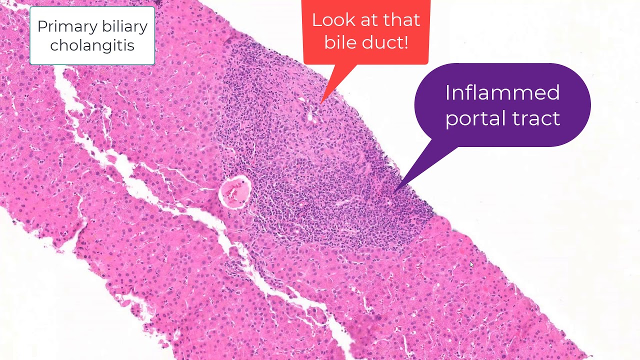 Primary Biliary Cholangitis - in 90 seconds! - YouTube