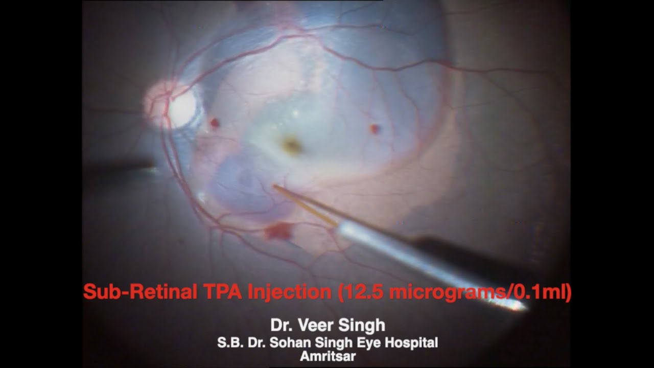 Retina Surgery for Sub-Macular Haemorrhage | Dr. Veer Singh | Dr. Sohan ...