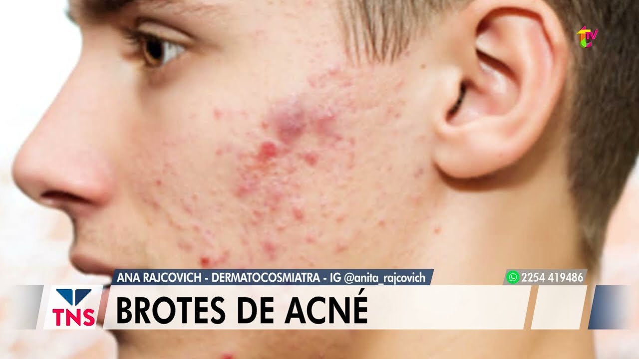 BROTES DE ACNÉ - YouTube