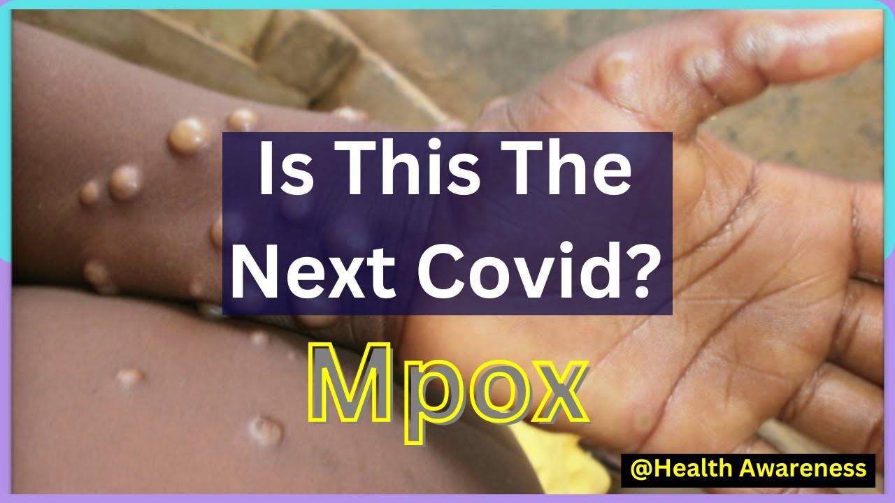 Mpox (Monkeypox) Awareness: Everything You Need to Know | Symptoms ...