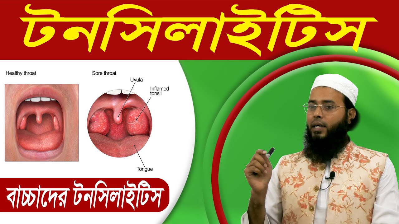 tonsil-infection-tonsil