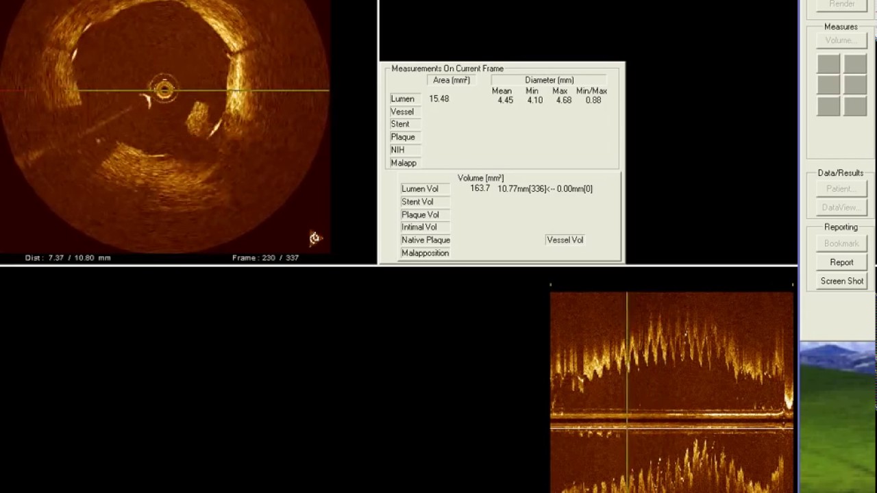 OCT DICOM Using INDEC echoPlaque - YouTube