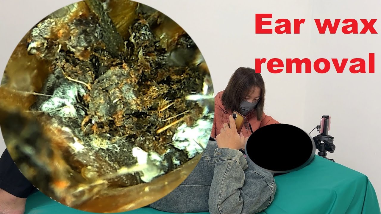 Ear wax removal | Giant earwax | ASMR | relaxation EP37 - YouTube