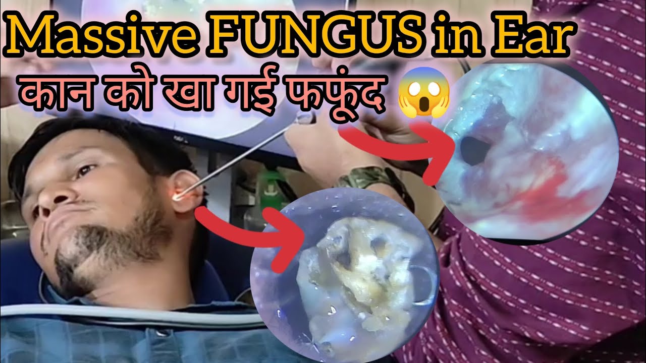 Massive Ear Fungus Removal with Endoscopic Microsuction! (Shocking ...