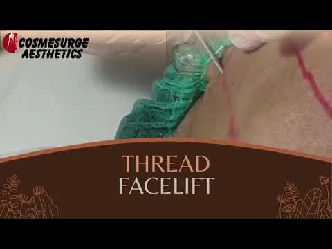 Thread face and neck lift / DR. YASIR ALLA QUDRE - YouTube