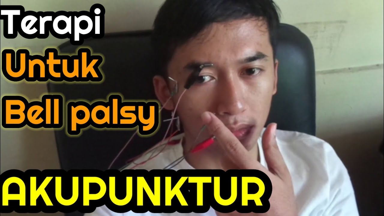 TERAPI AKUPUNKTUR II memgobati Bell palsy - YouTube