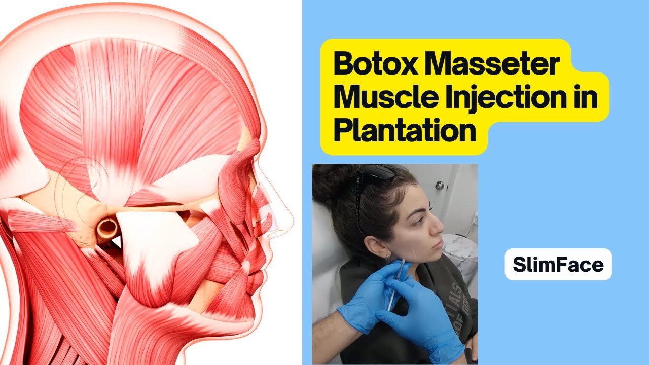 Botox Masseter Muscle Injection In Plantation To Slim The Face #botox # ...