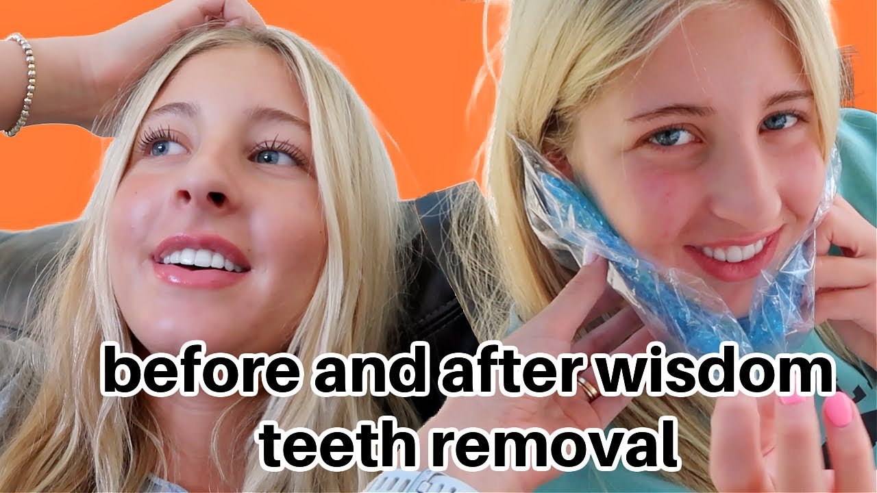 She Got Her Wisdom Teeth Out Youtube 1798