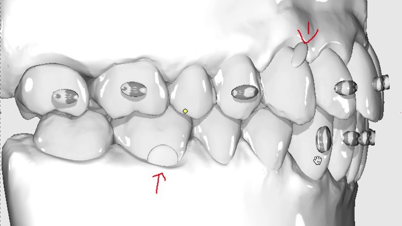 Precision cuts now available on white label aligners, Class 2, Class 3 ...