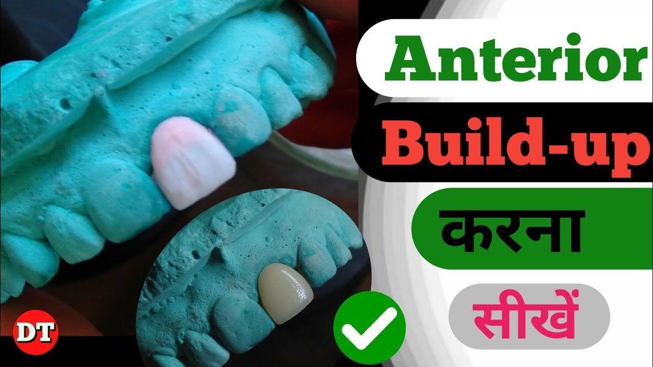 Anterior Build up Techniques || Ceramic Anterior porcelain| dental ...