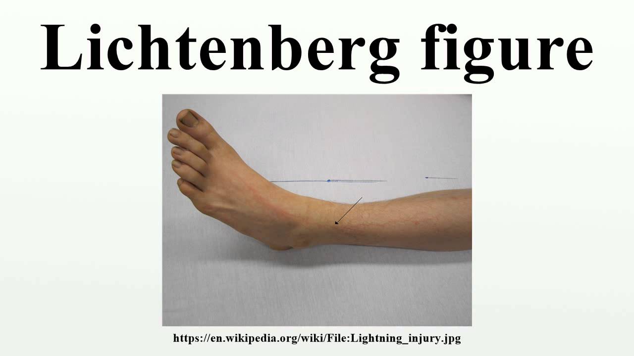 Lichtenberg figure - YouTube