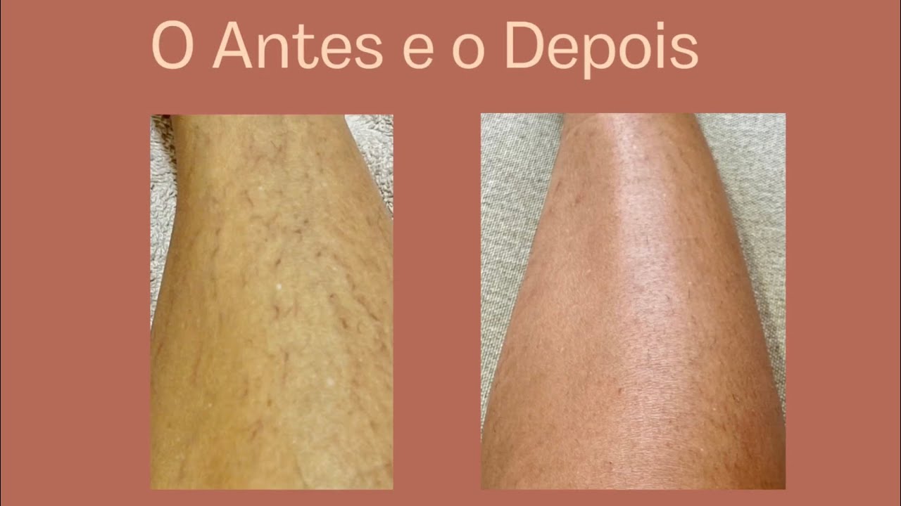 Escleroterapia para tratar microvarizes - YouTube