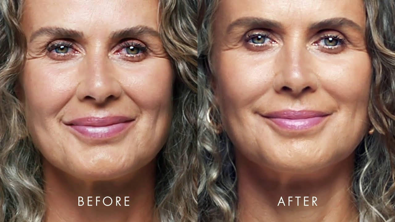 Revance and RHA fillers are the new class of Designer Fillers. - YouTube