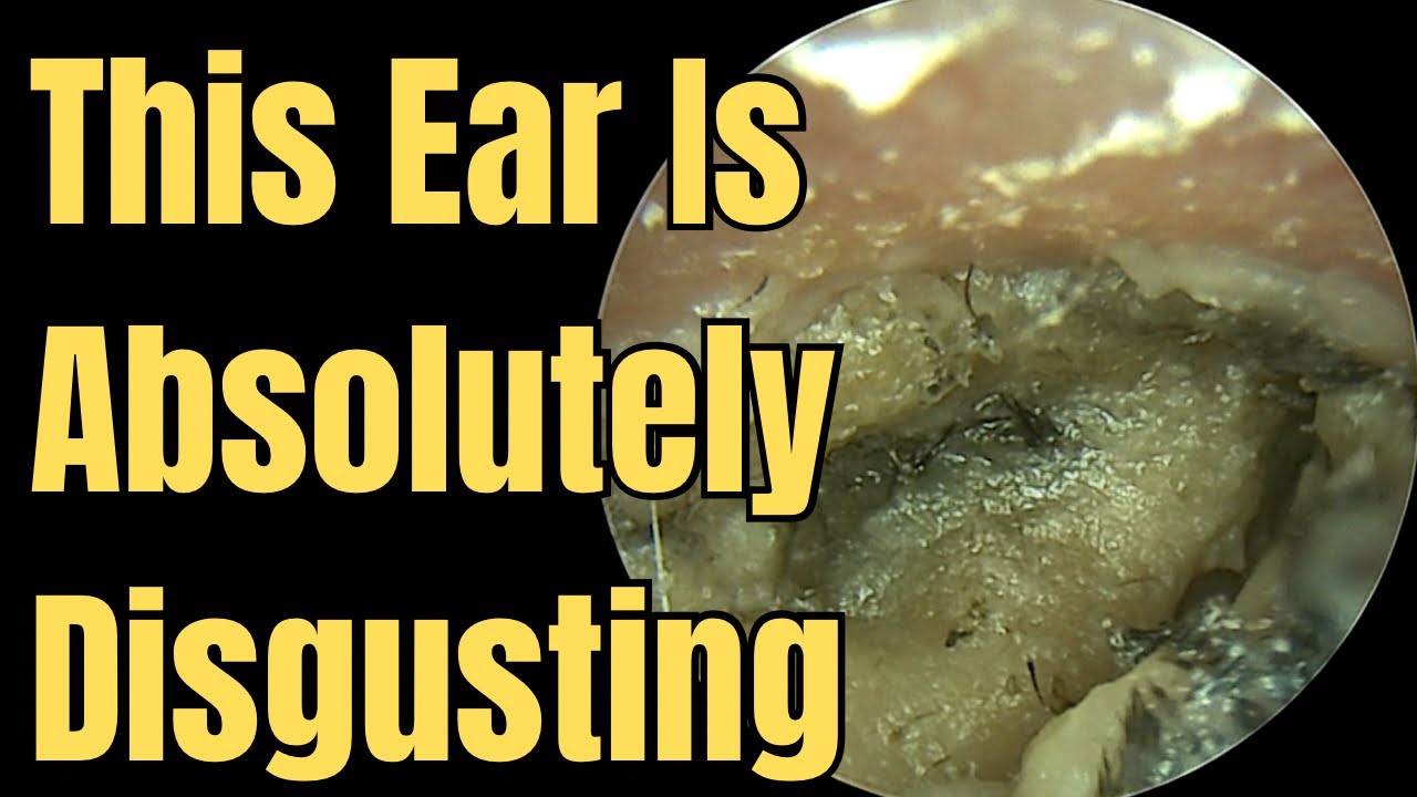 This Ear Is Absolutely Disgusting - YouTube
