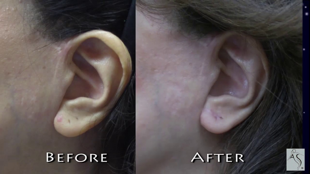 ear lobe reduction surgery - YouTube