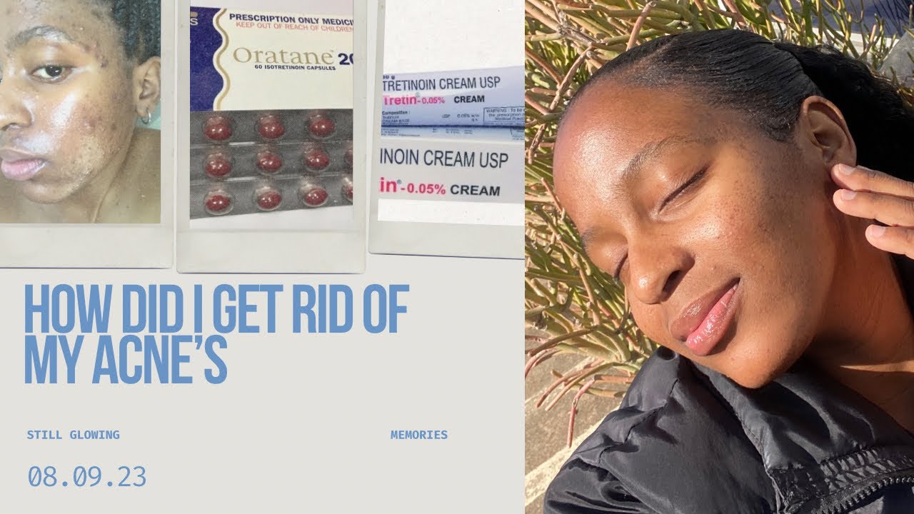How did I get rid of my ACNE’S using ORATANE PILLS||| South African ...