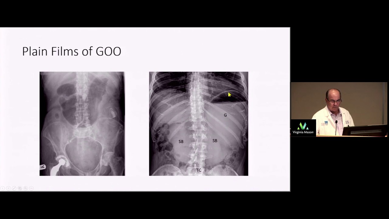 Treatments for Gastric Outlet Obstruction (GOO): Established and ...