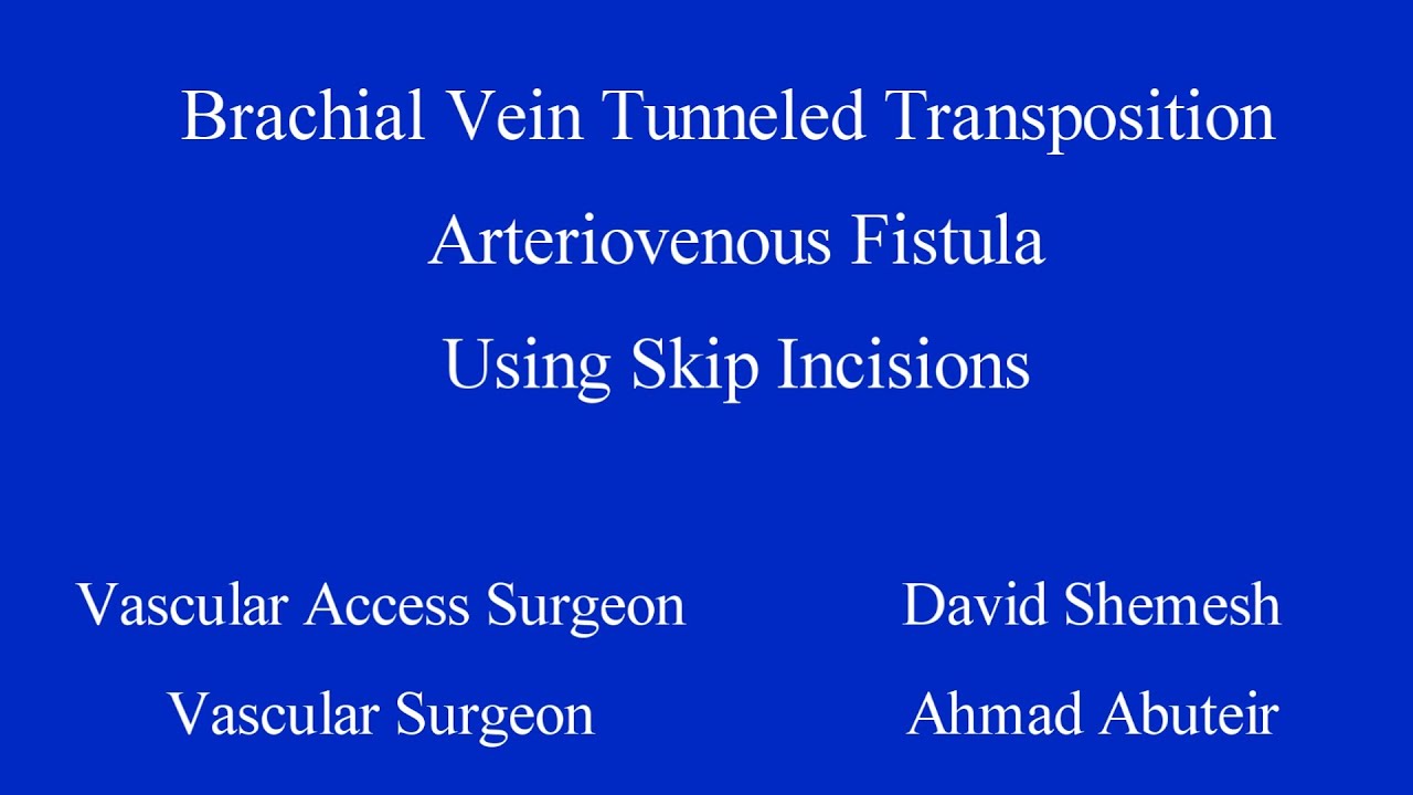 Brachial Vein Transposition Fistula - YouTube