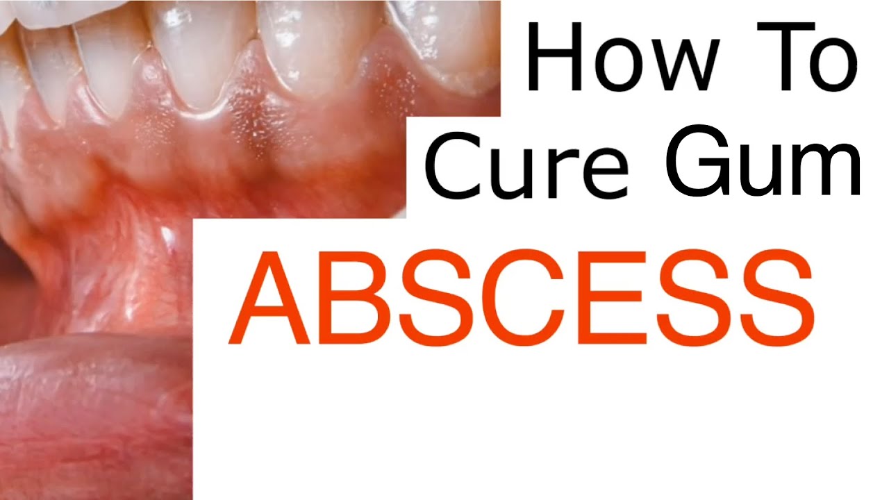 Gum Abscess Explained - YouTube
