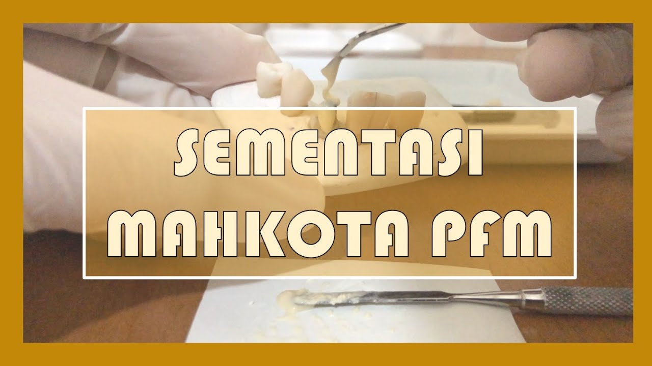Tahapan Sementasi Mahkota PFM (Porcelain Fused to Metal) didalam ...