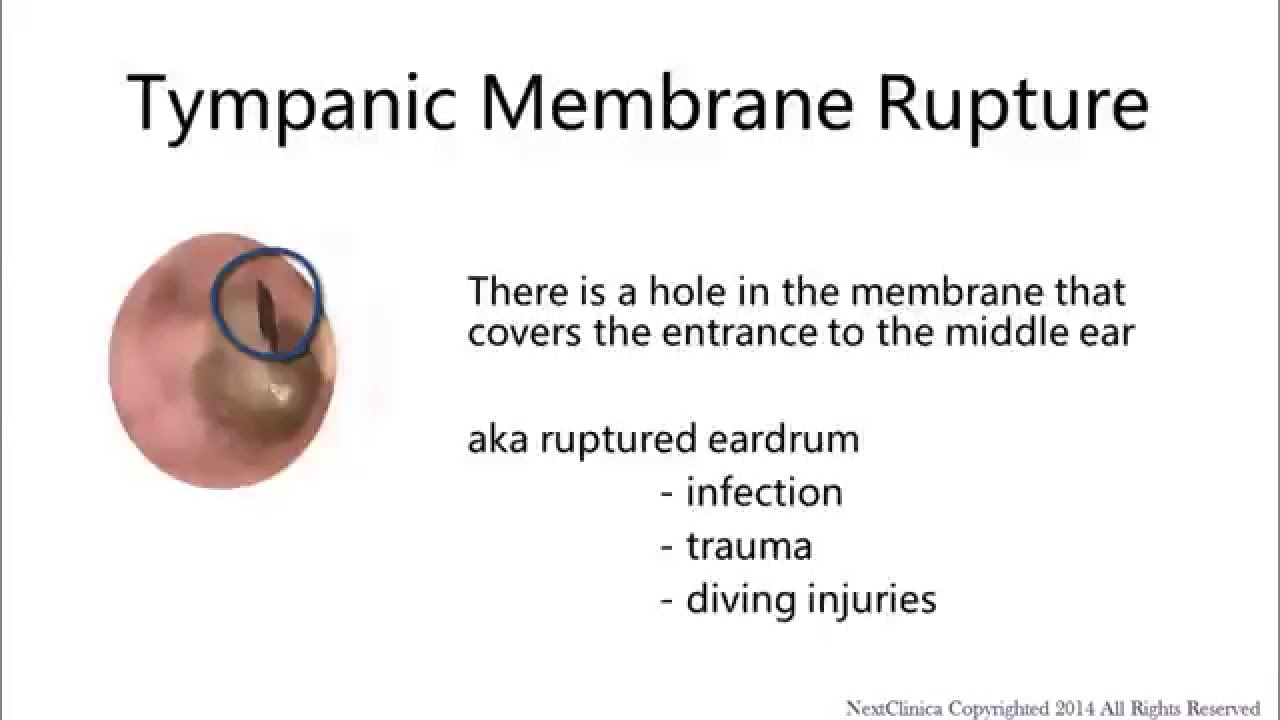 Tympanic membrance rupture - YouTube