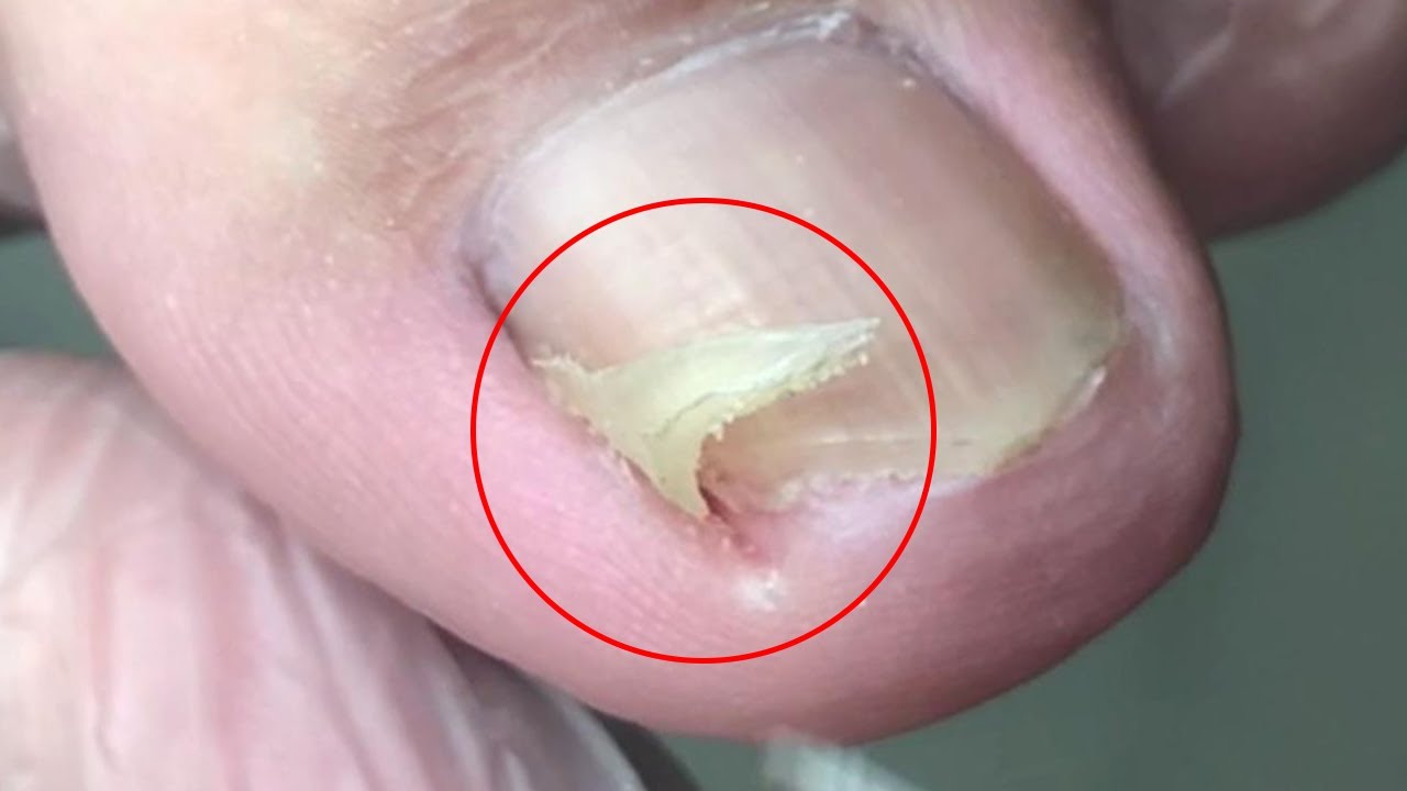 Triangle Toenails! Easy to aggravate toes! 【Dr Zhang】 - YouTube