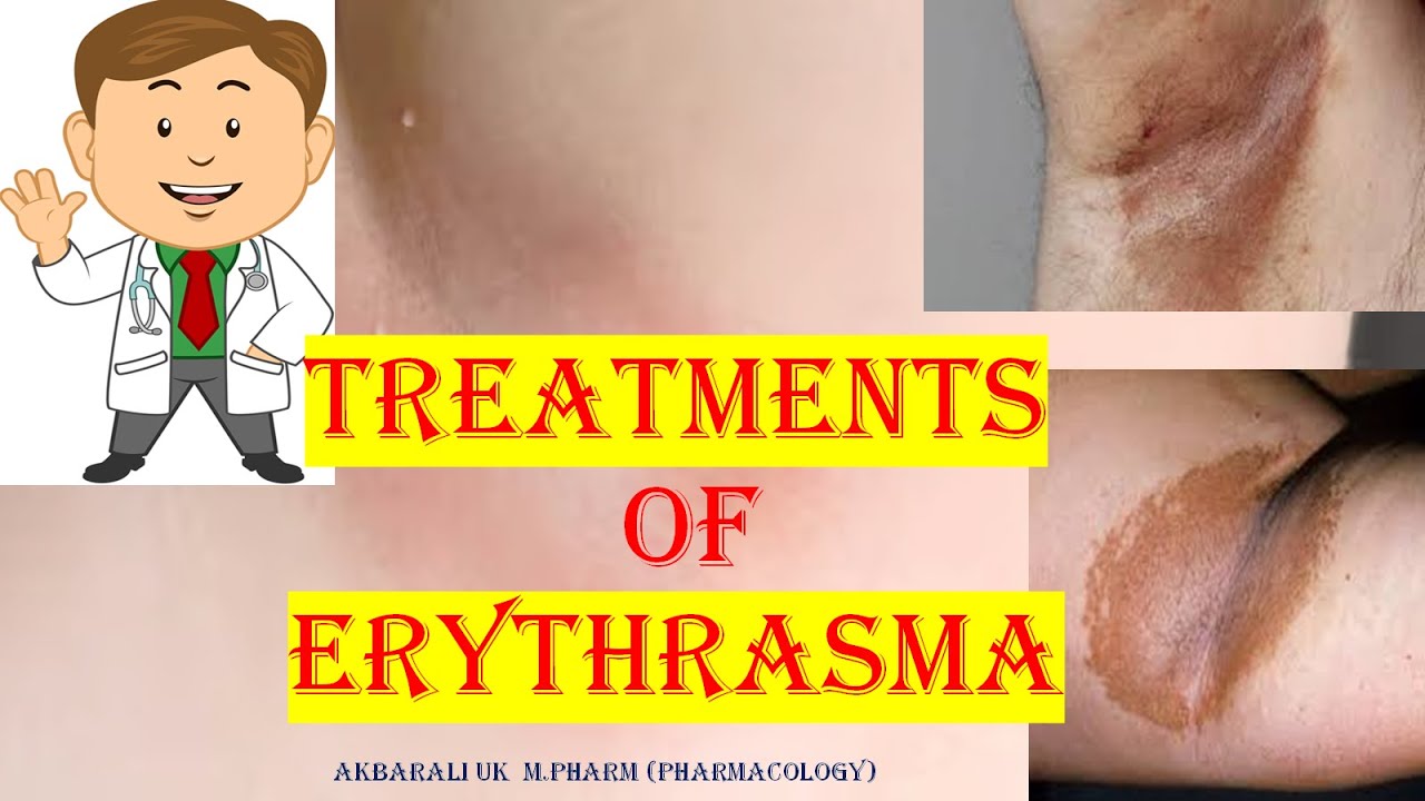 MEDICINAL TREATMENTS OF ERYTHRASMA - YouTube