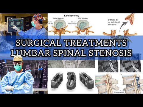 Surgical Treatment For Lumbar Spinal Stenosis (Part 2)