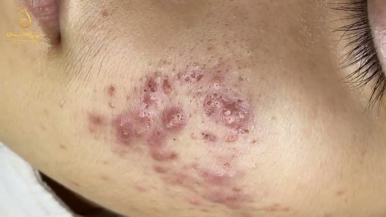 Make your Acne Treatment | Acne spa 987 | Acne spa Treatment - YouTube