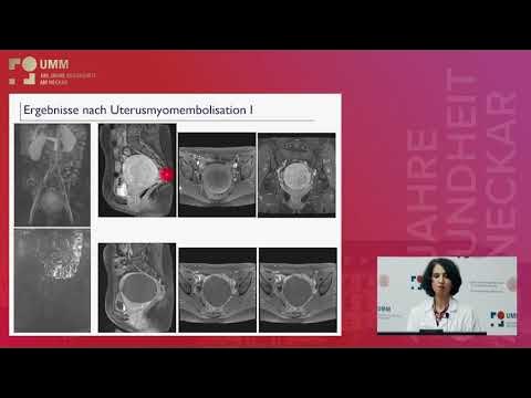 Gebärmuttermyome: Radiologisch-interventionelle Therapie - YouTube