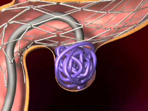 Aneurysm coil embolization - YouTube