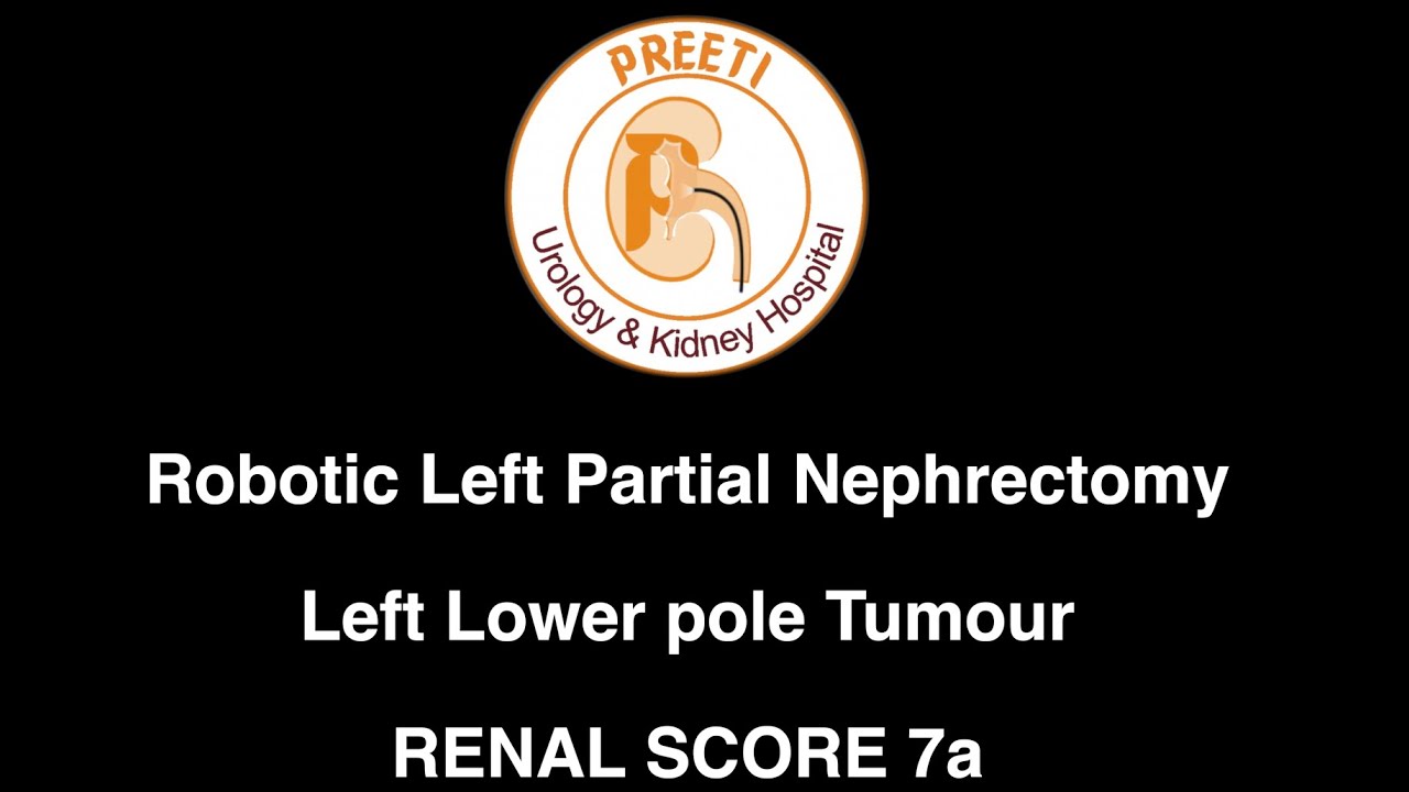 Robotic Left Partial Nephrectomy Left Lower pole Tumour RENAL SCORE 7a ...
