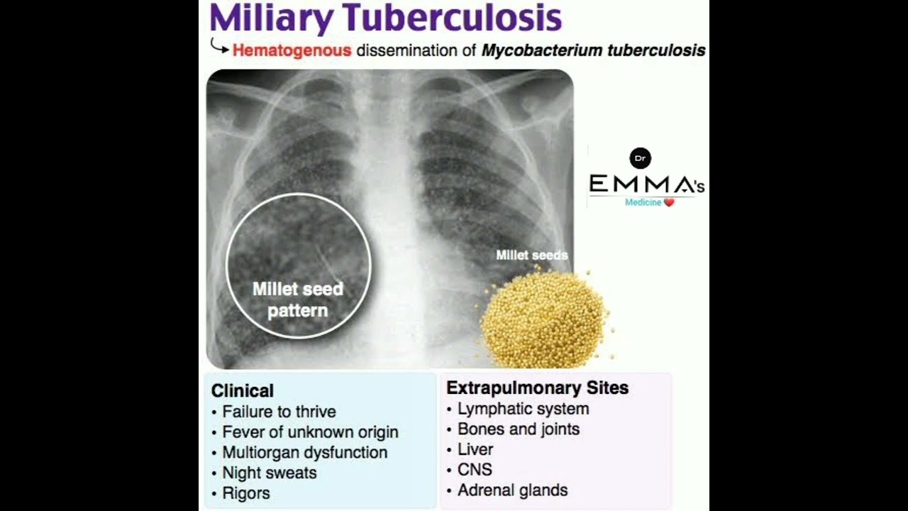 Miliary Tuberculosis