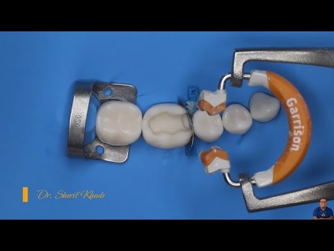 Sectional Matrix Placement Technique - YouTube