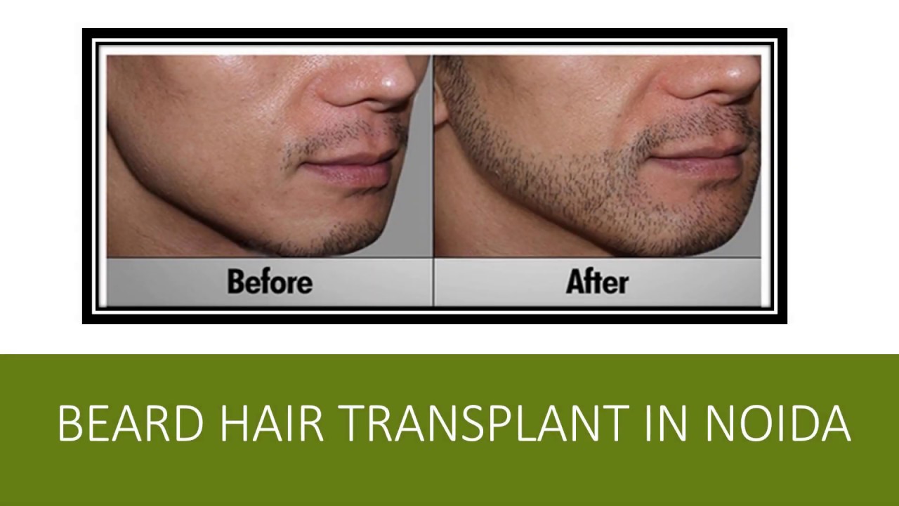 Beard Hair Transplant in Noida Whatsapp at +91-9315799606 for More ...