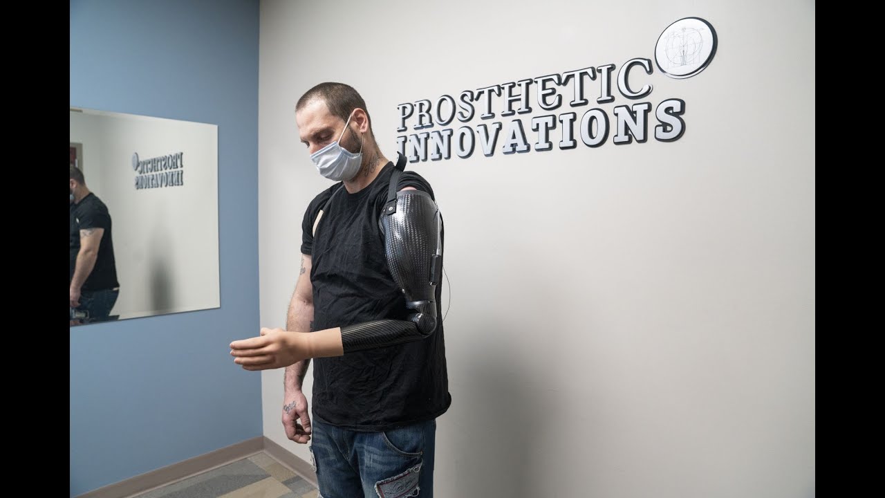 Steeper Espire Pro Myo Electric Elbow | Linear Transducer | Prosthetic ...