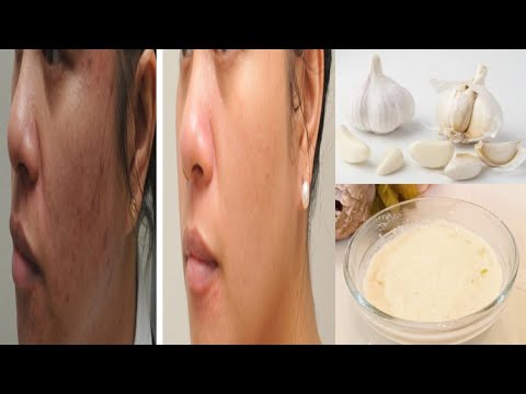Skin Whitening & Anti-aging Garlic Face Pack to get Fair, AcneFree and ...