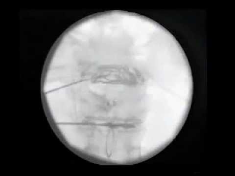 Intervertebral Disc Leak and High Intensity Zone - YouTube