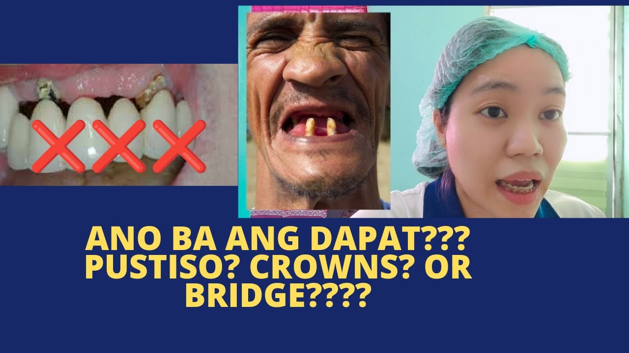 Pustiso, Jacket Crown at Dental Bridge : Alamin Ang Pagkakaiba-iba ...
