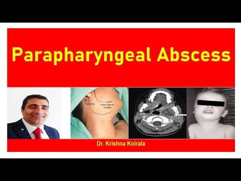 Parapharyngeal abscess //Dr Krishna Koirala //Dr Krishna's ENT Lectures ...