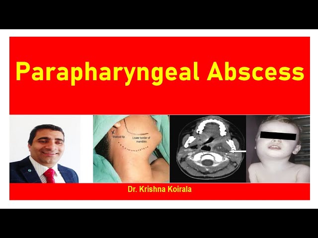 Parapharyngeal Abscess