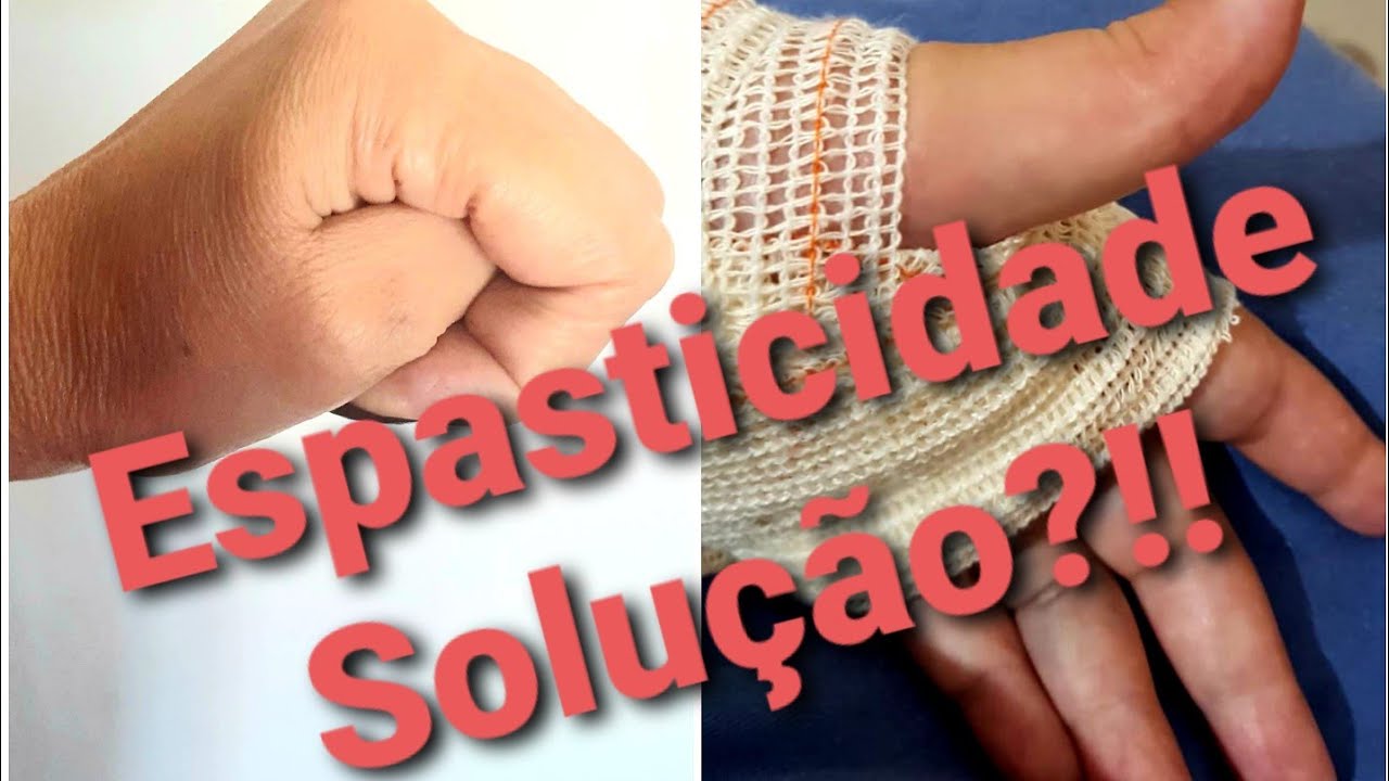 Adeus espasticidade. tratamento da espasticidade - YouTube