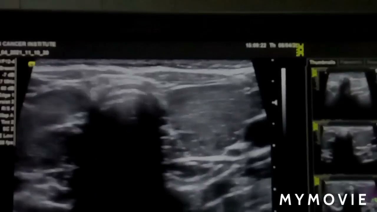 Thyroid inferno in a hypoechoic inhomogeneous thyroid gland | US case ...